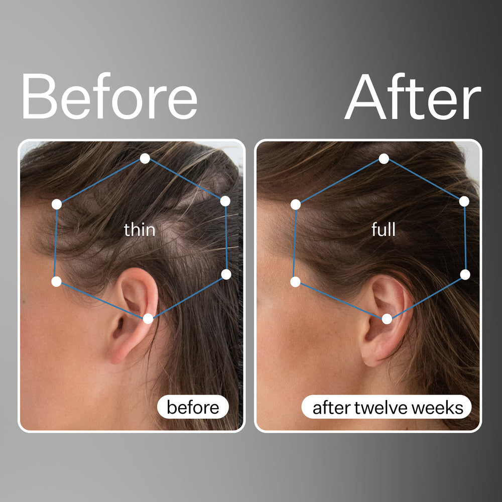 0.25mm Scalp Dermaroller – Act+Acre UK